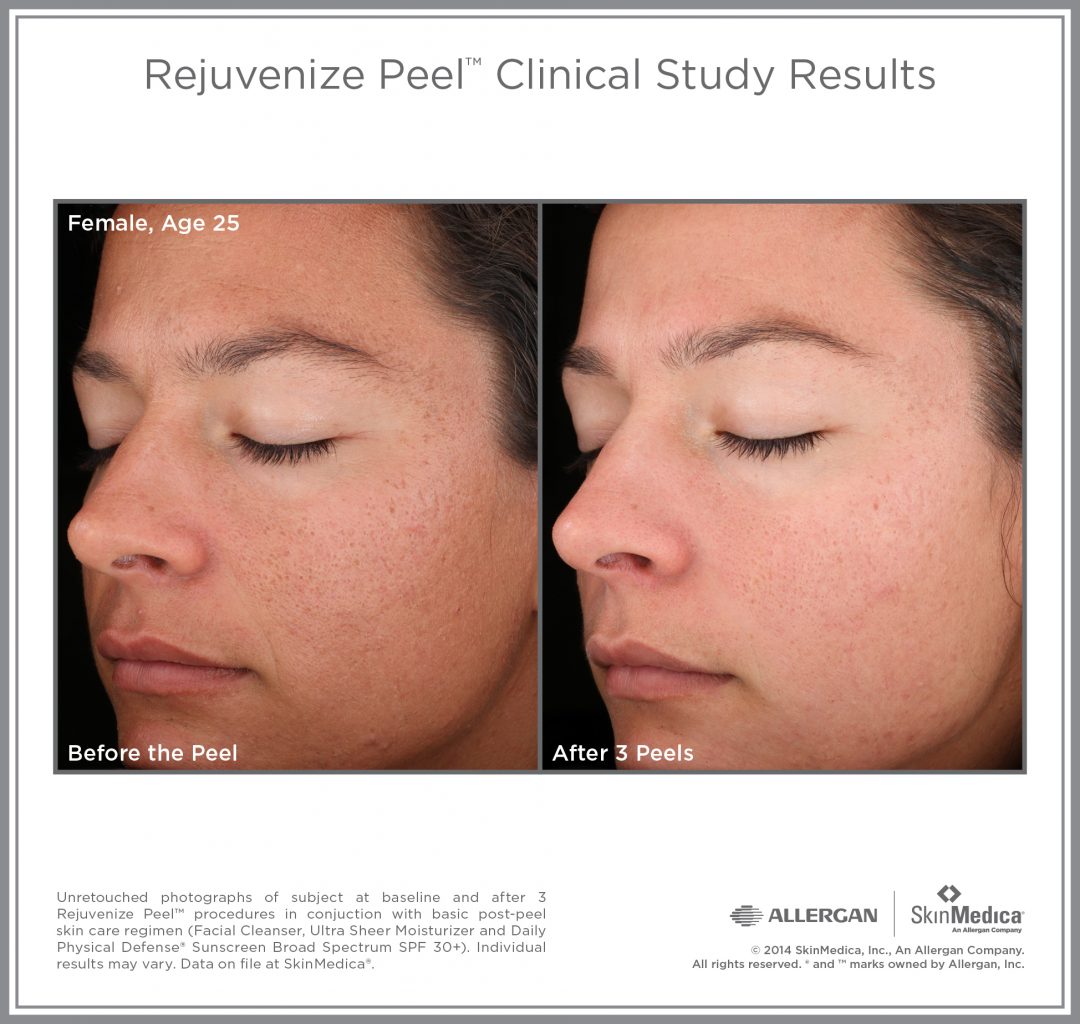 Chemical Peels | Millennium Med Cosmetics
